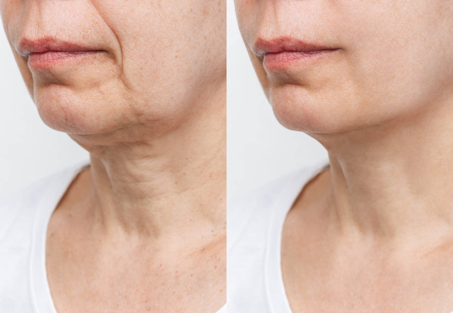 Neck Mask Lifting Hydrating Firming Treatment (5 Masks)